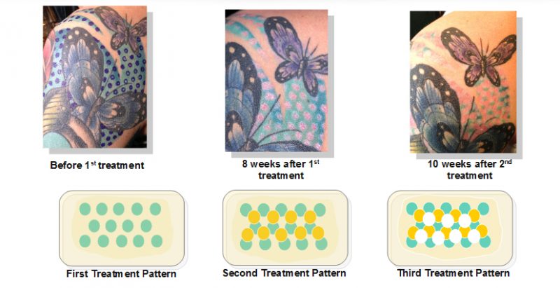 Tatt2Away Tattoo Removal | Non-Laser, Safe, and Effective - Tattoo ...