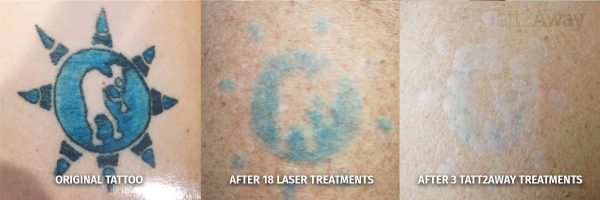 Tatt2Away Tattoo Removal | Non-Laser, Safe, and Effective - Tattoo ...
